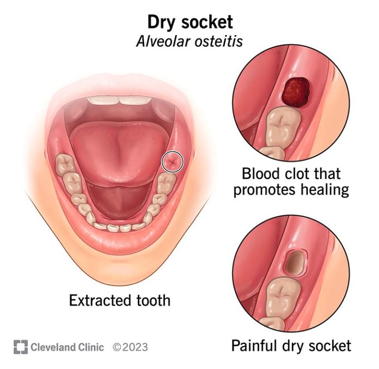 Dry Socket: Symptoms, Causes, Treatment, and Prevention